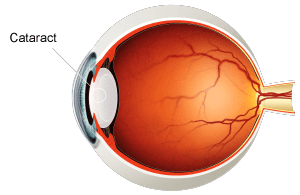 Cataract FAQ | What Are Cataracts? | Specialty Eye Institute