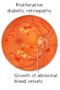 Non-Proliferative & Proliferative Diabetic Retinopathy & Treatments ...