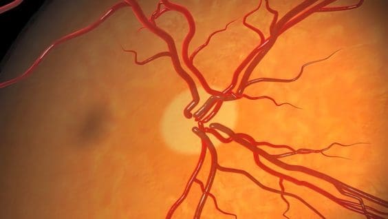 What Causes Optic Nerve Damage?