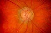 Vitreous Detachment Symptoms & Causes | Specialty Eye Institute