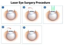What Happens During LASIK Surgery? LASIK Procedure Steps